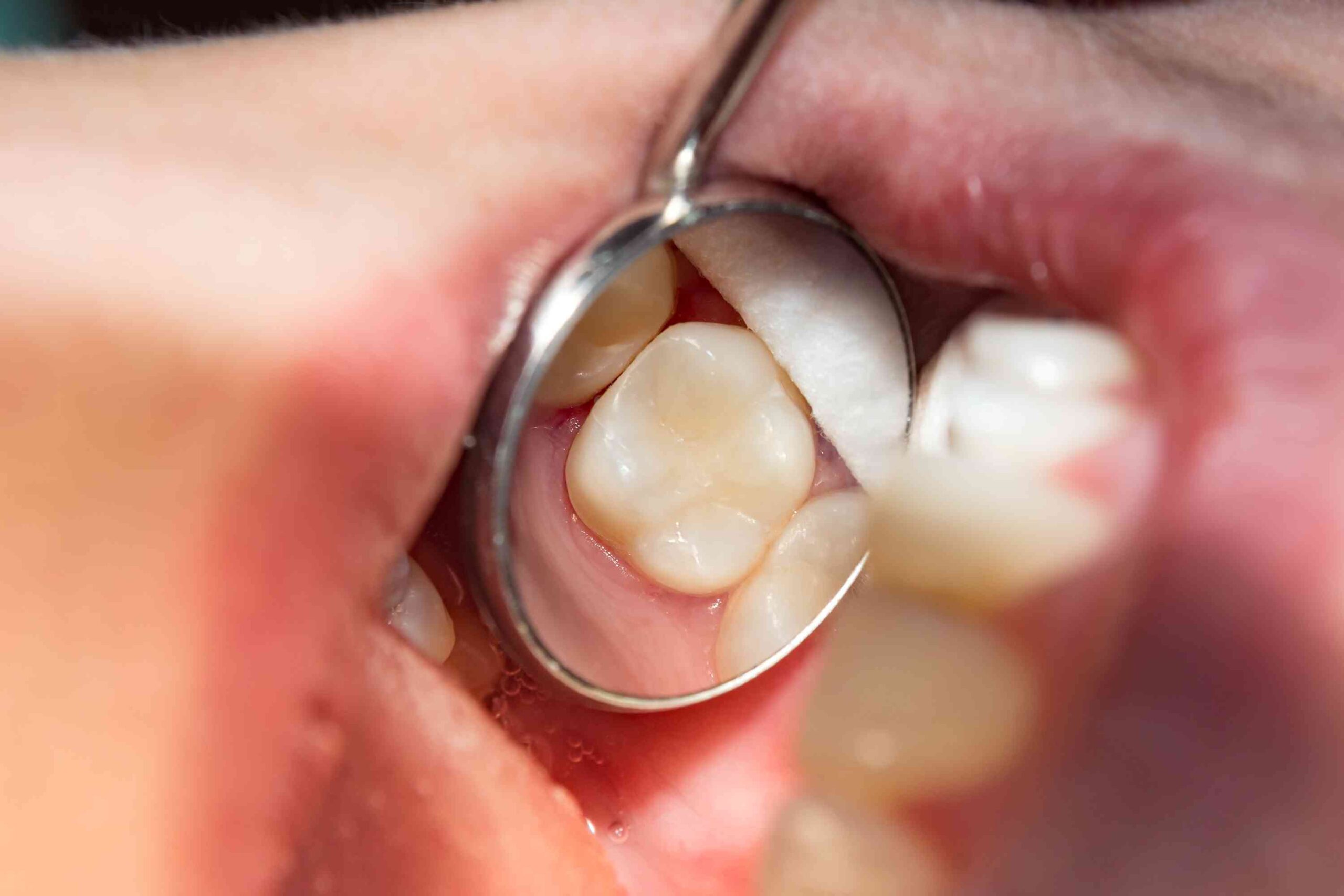 Dental Crowns vs. Dental Fillings, Irving | 21st Century Dental of Irving
